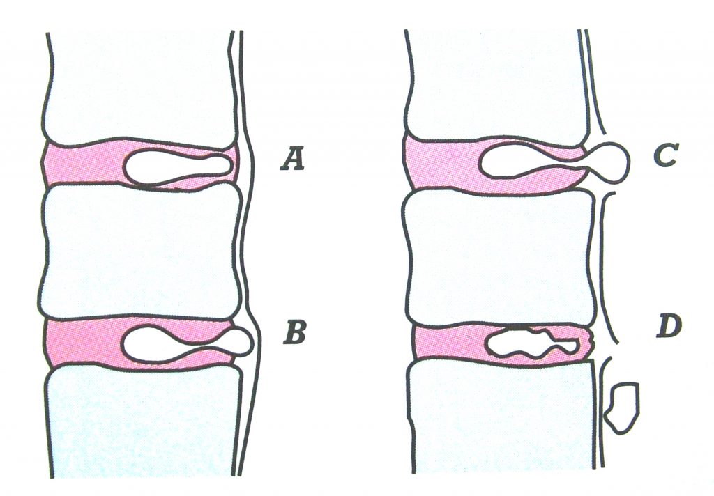 La hernie discale expliquée - Douleur-Info.com